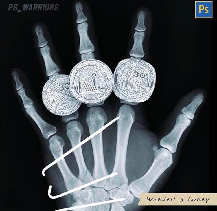 Leaked image of Steph’s X-rays | Scrolller