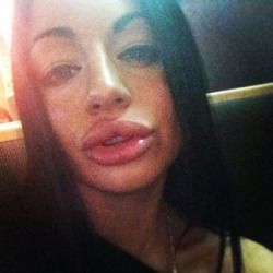 Lips injections | Scrolller