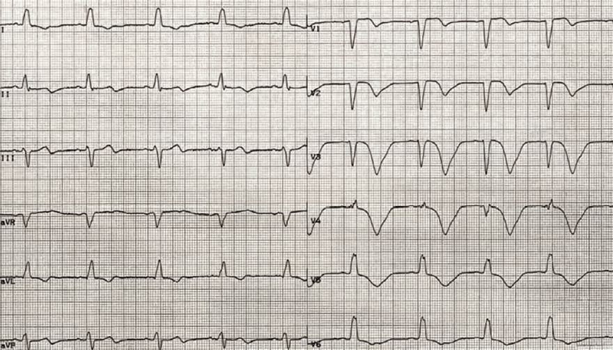 Med student here, still new to ECG. Please help me understand what I'm ...