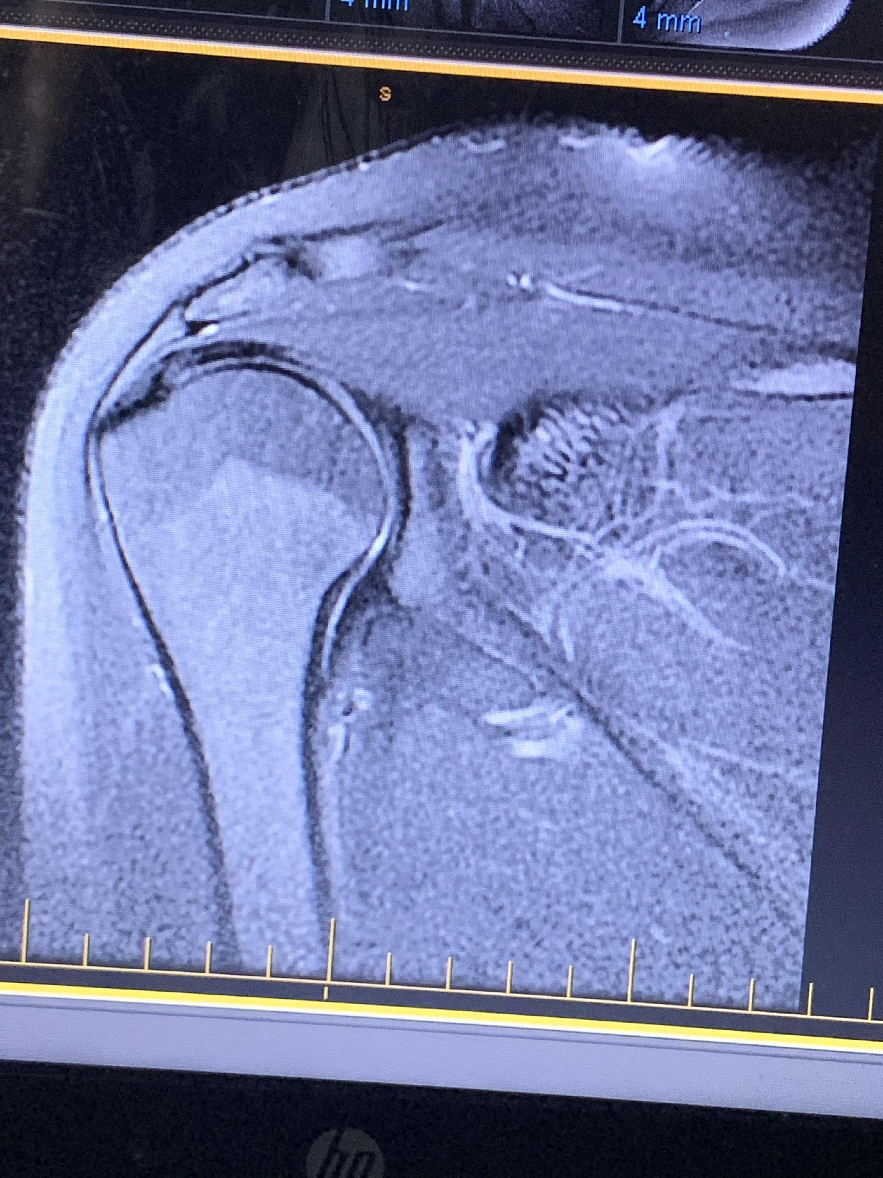 MRI of shoulder. What is jellyfish like structure? 20/F | Scrolller
