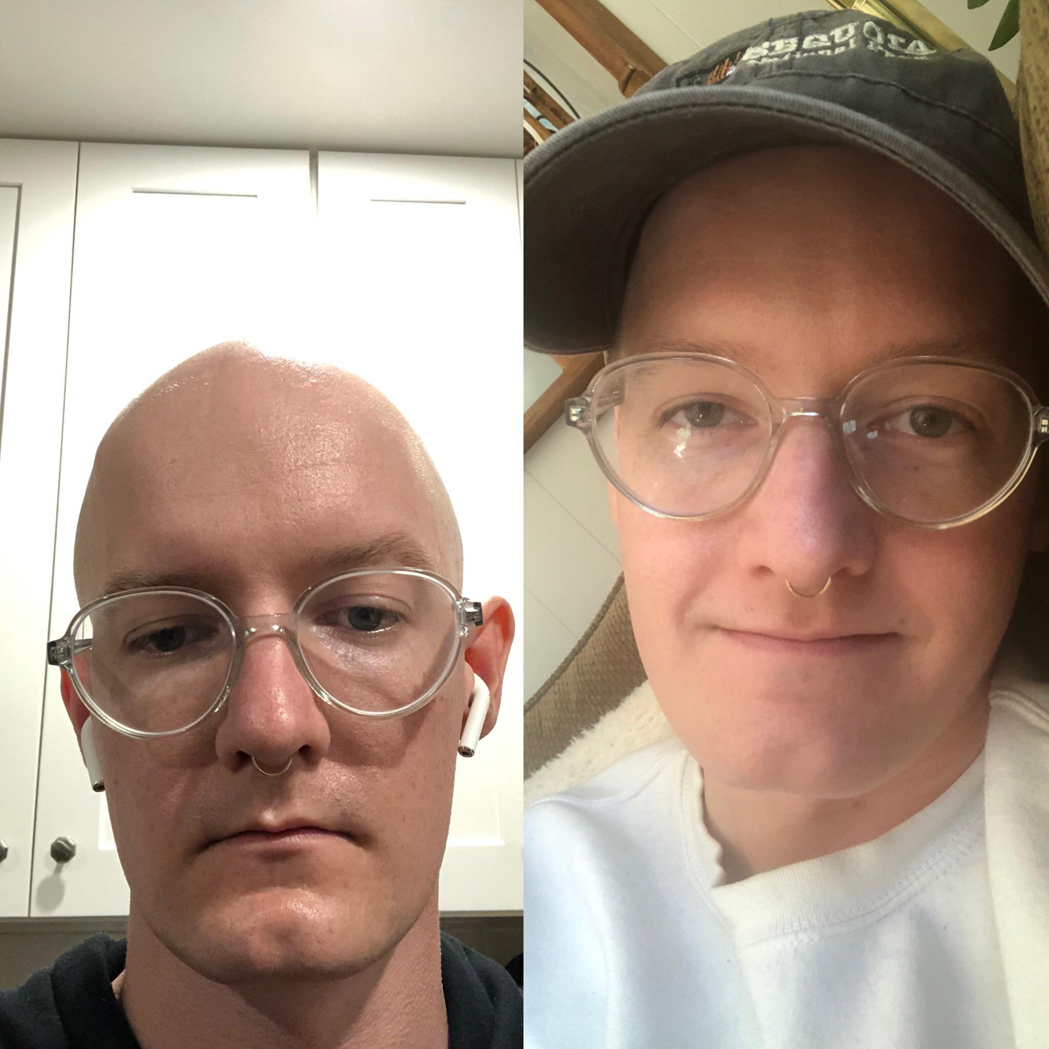 [mtf] Left: day 1 HRT. Right: day 102. | Scrolller