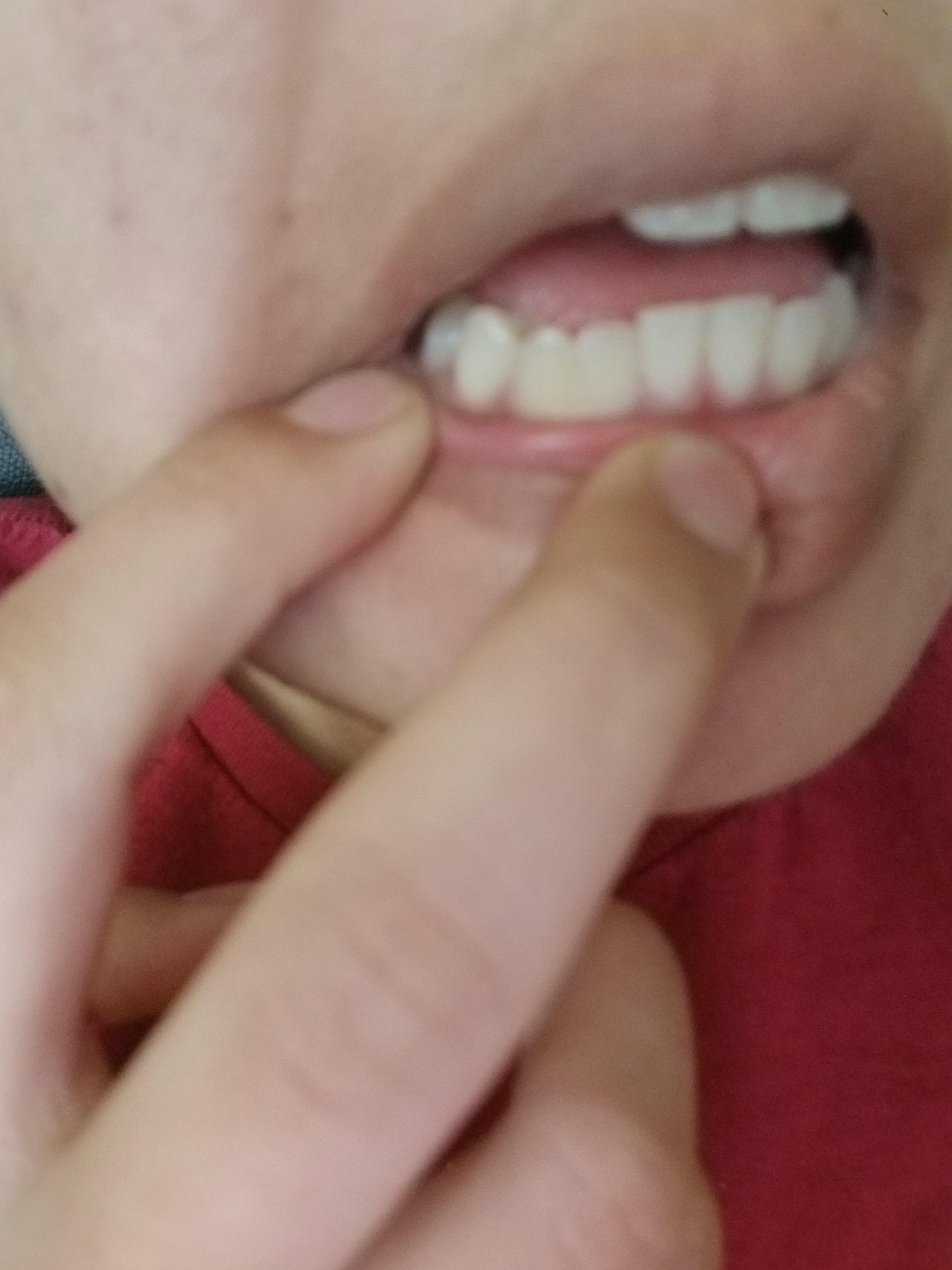 My fused tooth | Scrolller