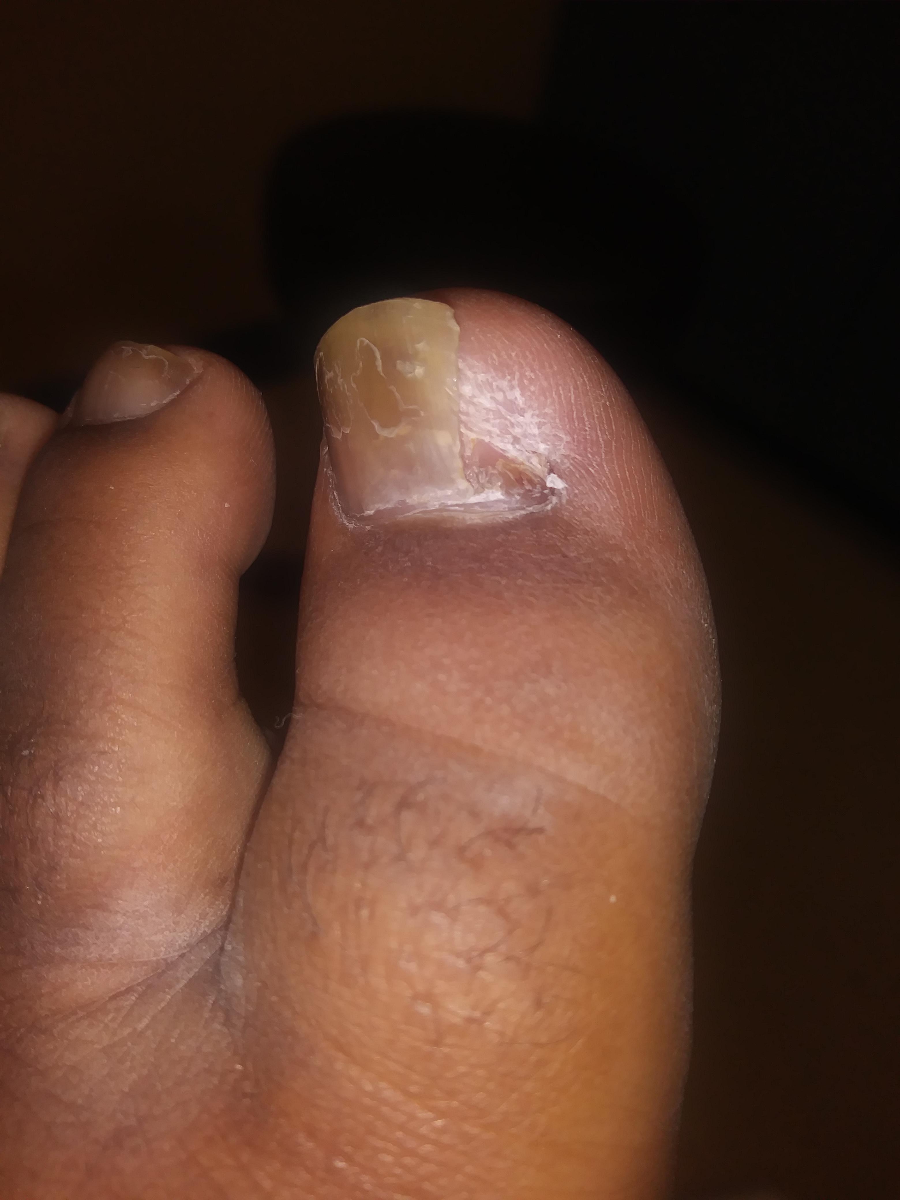 My ingrown toenail | Scrolller