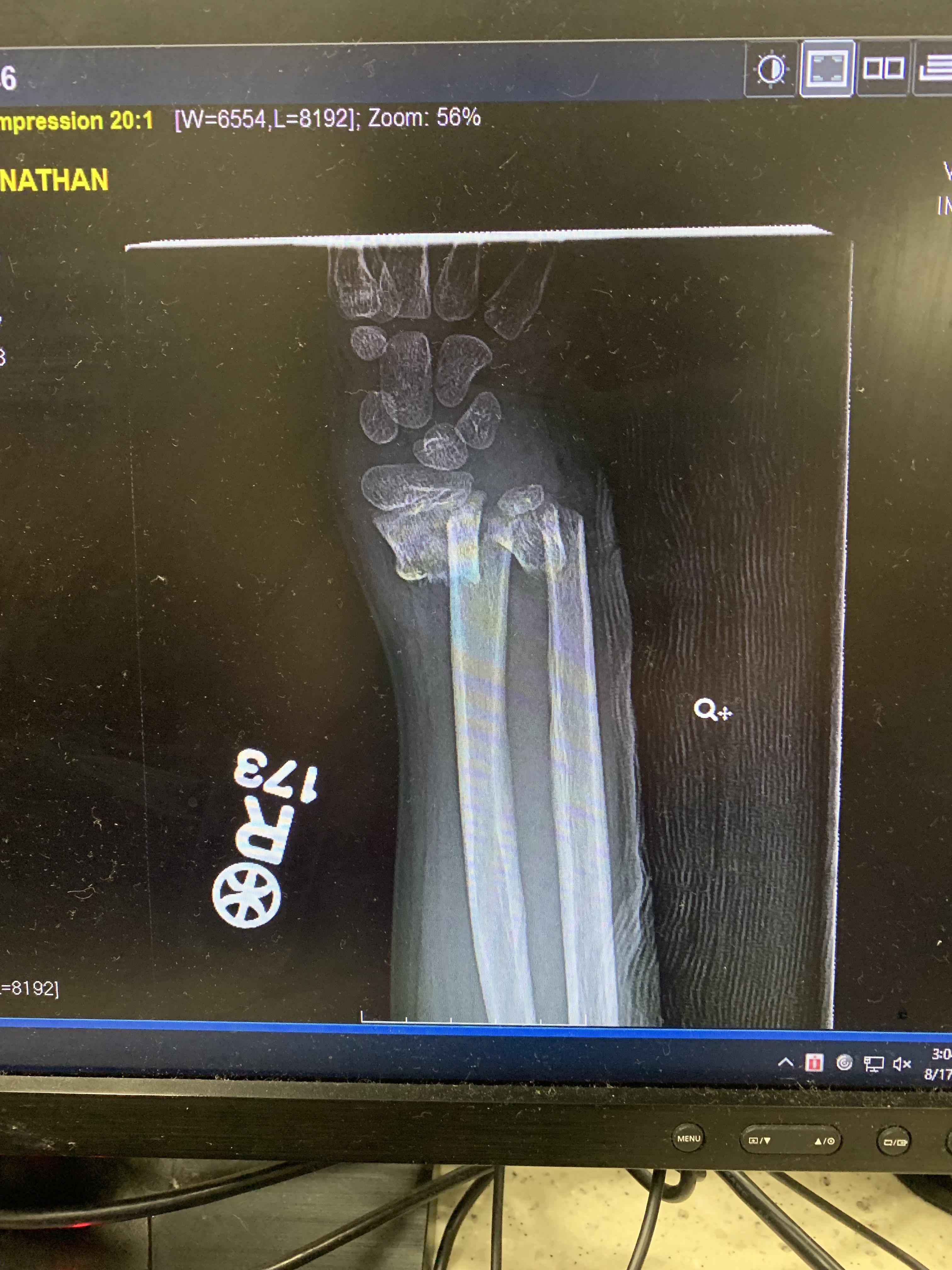 My little brother’s broken arm... | Scrolller