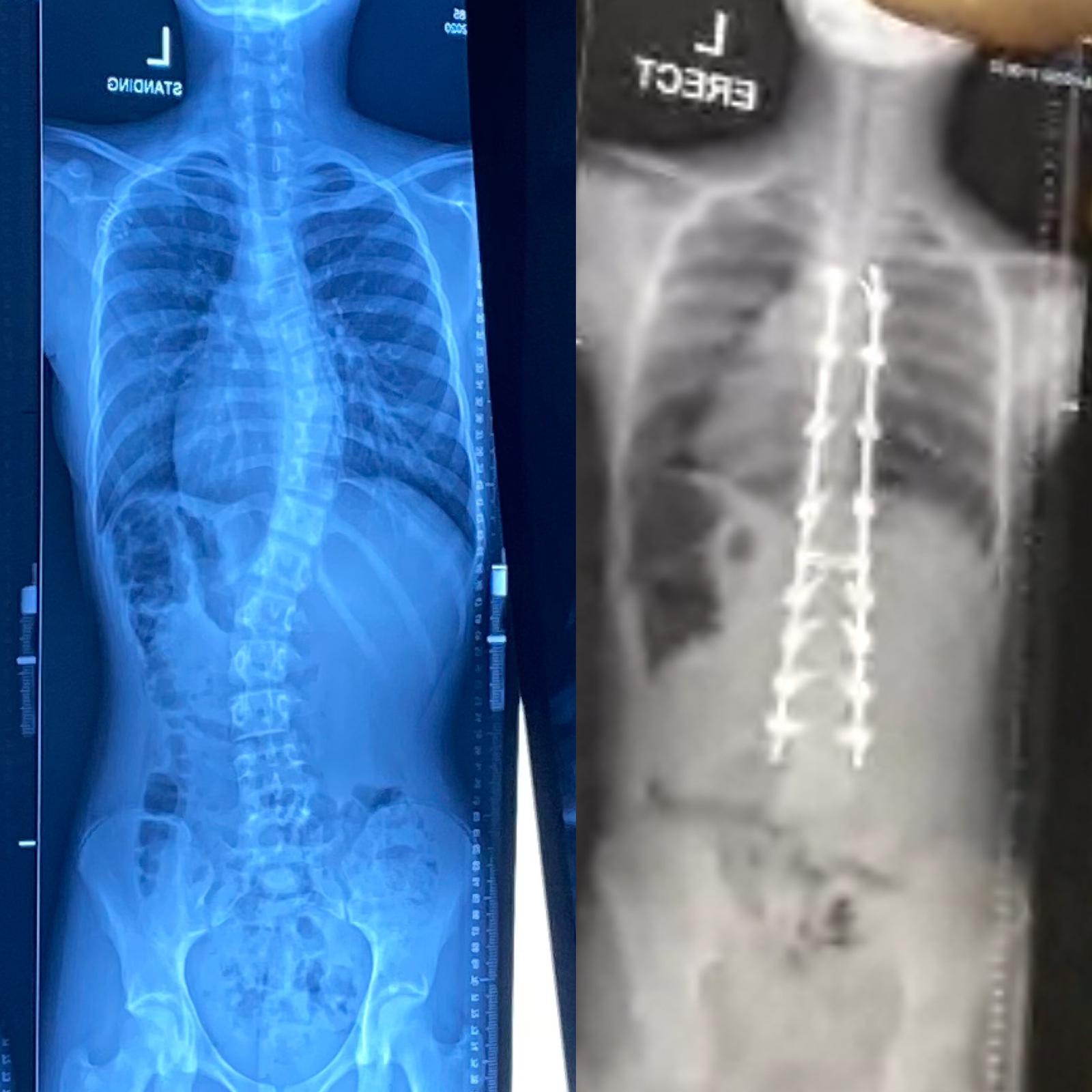 My scoliosis x rays! | Scrolller