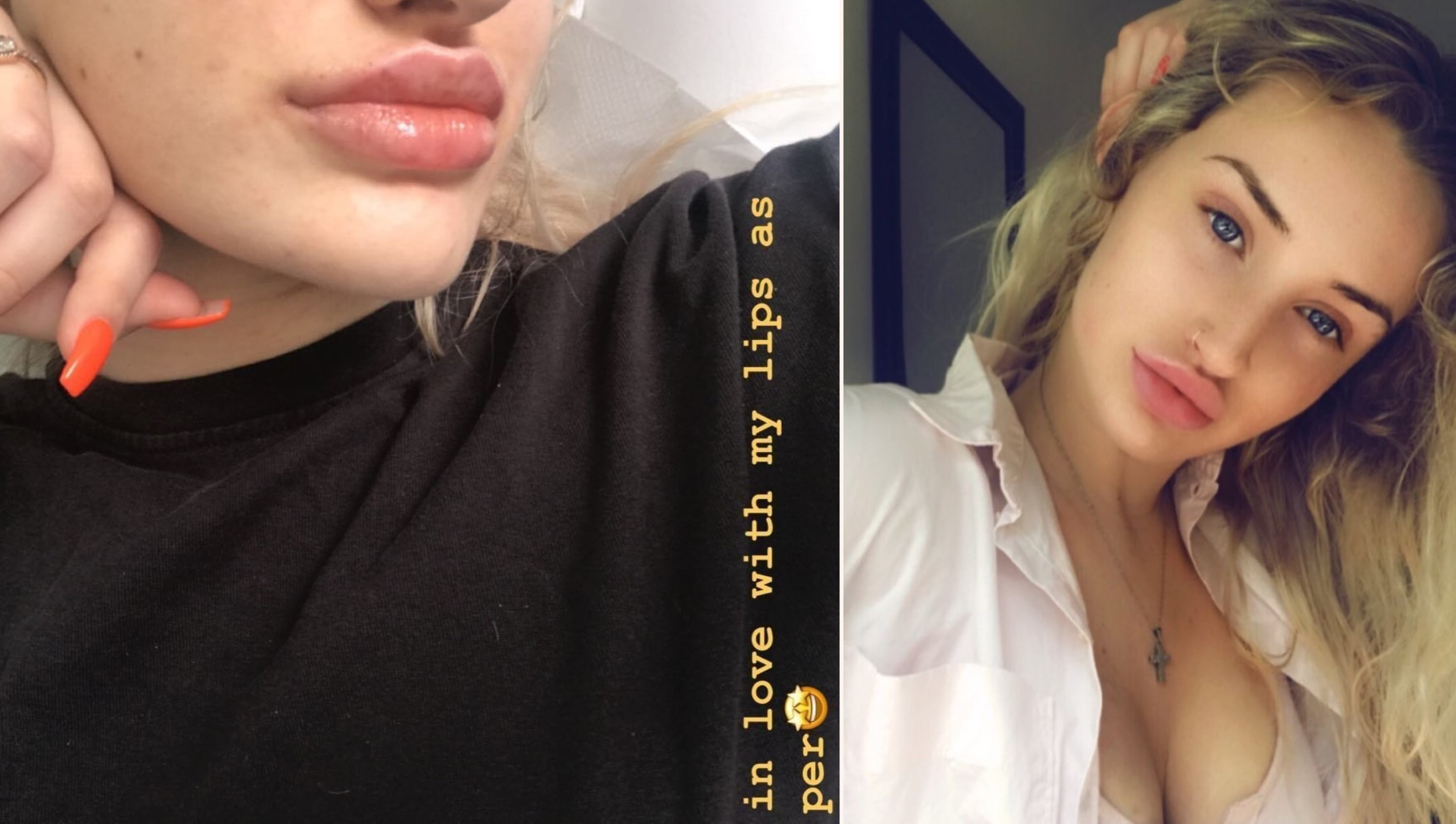 New lips | Scrolller