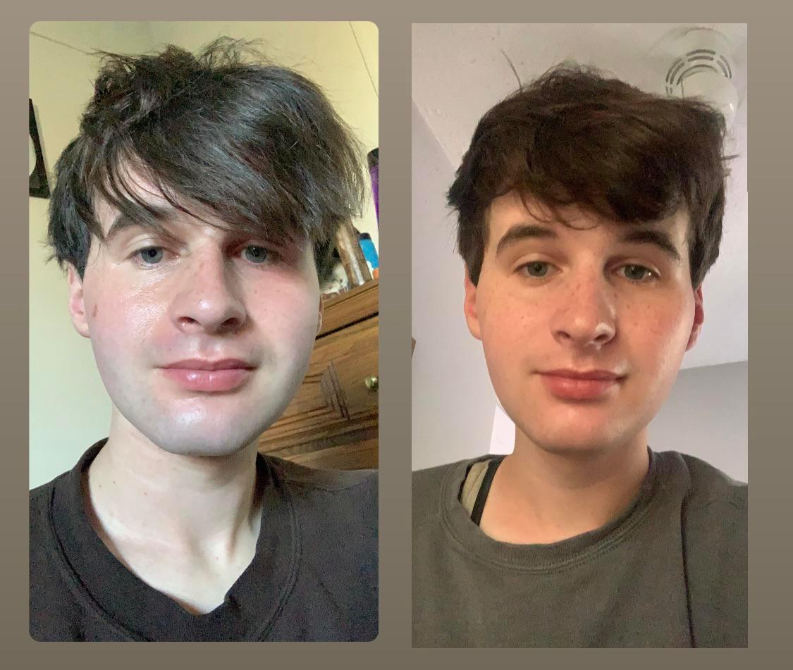 OIL BE GONE!! 7 months HRT, 2 sessions laser, and still in boymode. | Scrolller