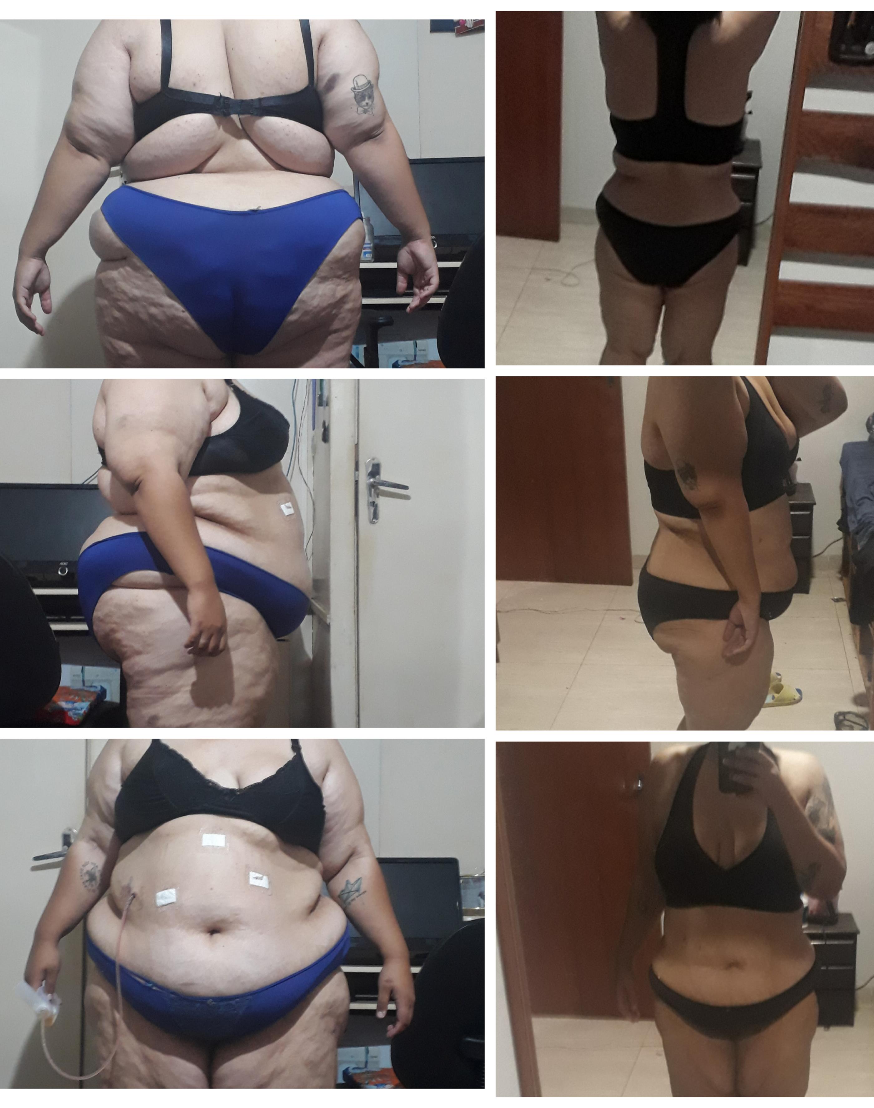 One year progress, bypass gastric 147 kg/ 89 kg | Scrolller