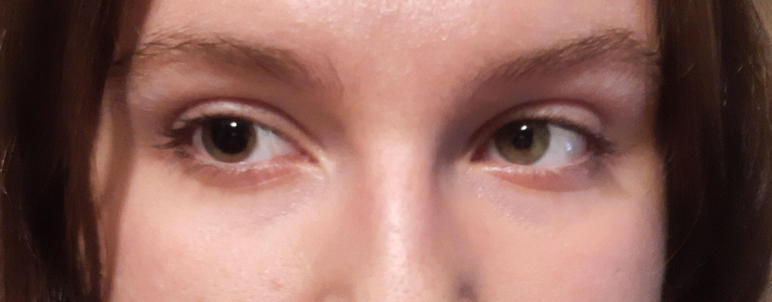 Optometrist only dilated one eye | Scrolller