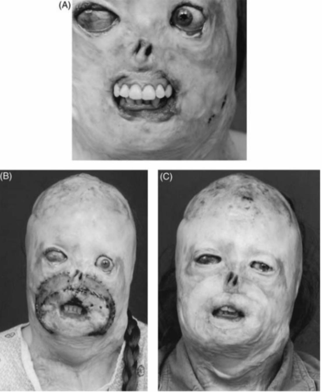 Reconstructive surgery to create lips for a burn victim. | Scrolller