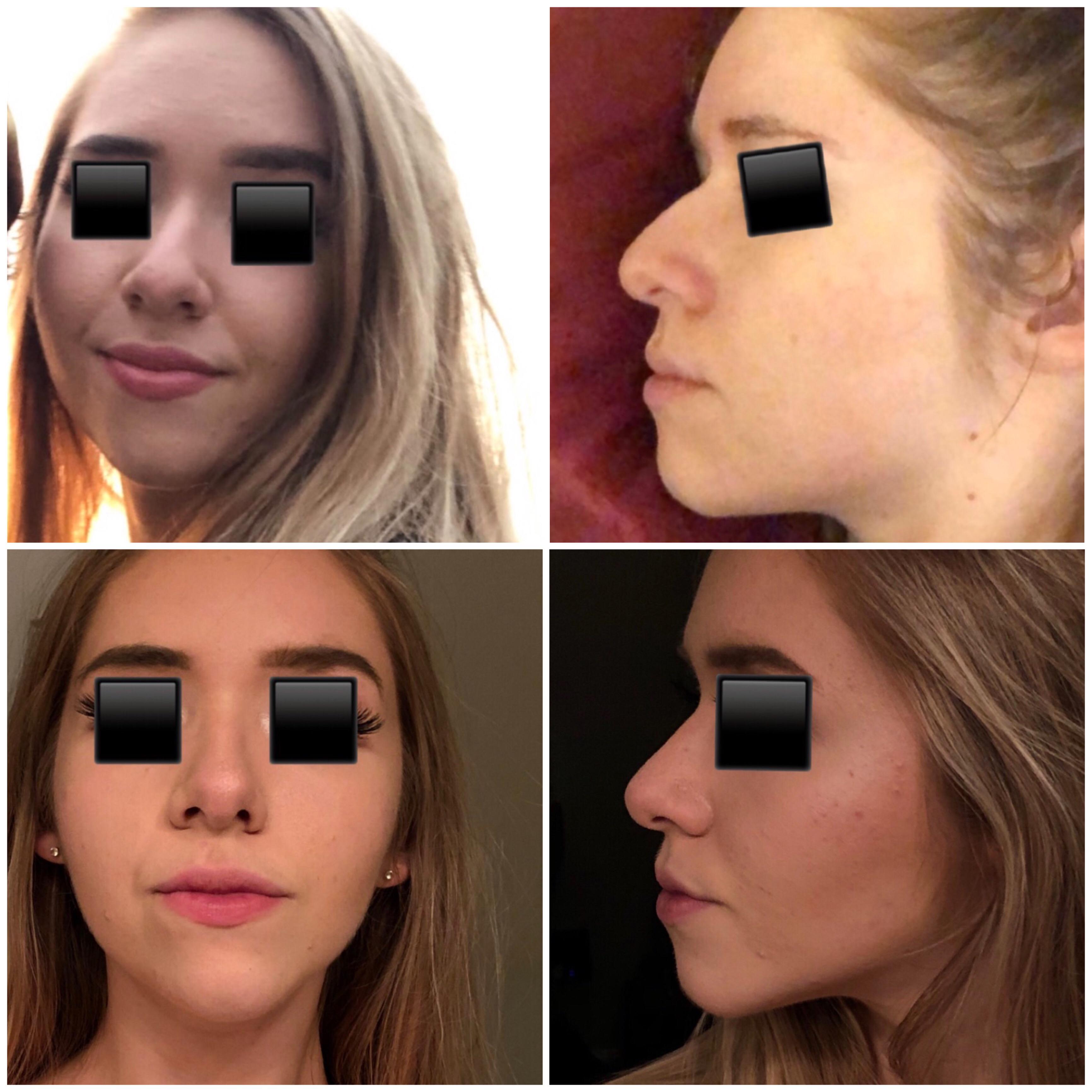 Rhinoplasty 1 month post-op! | Scrolller