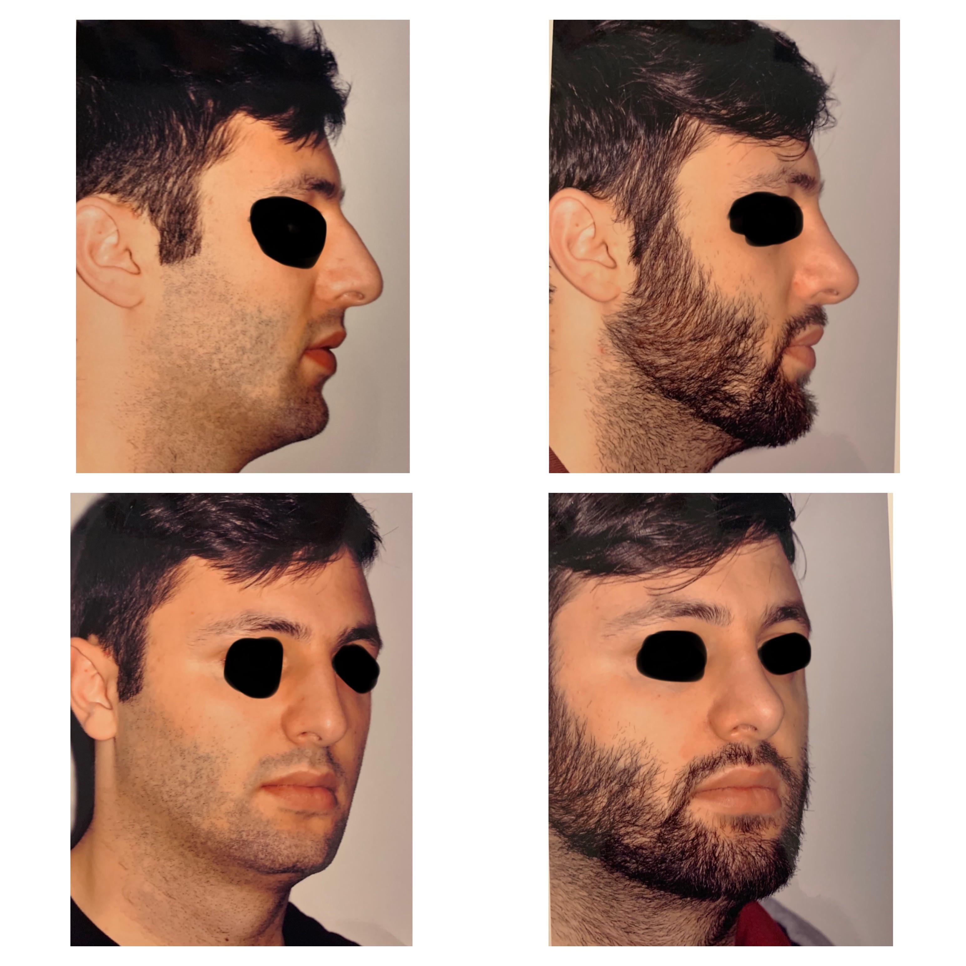 Rhinoplasty 1 year post op | Scrolller