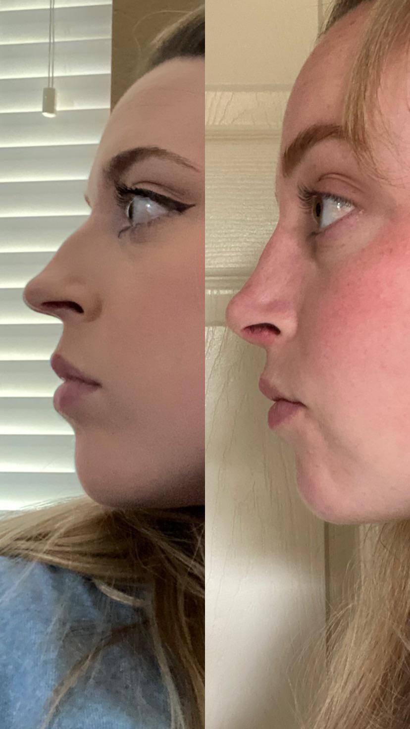 Rhinoplasty 2 Months post-op | Scrolller