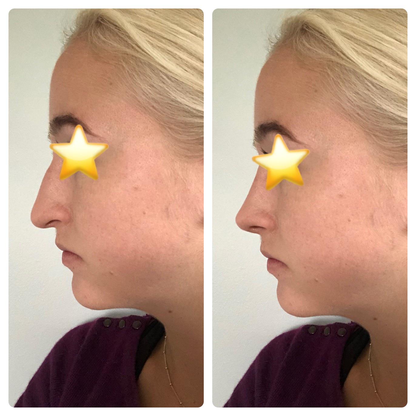 Rhinoplasty before/after simulation | Scrolller