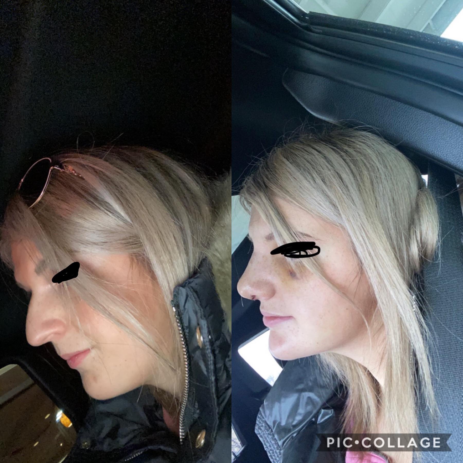 Rhinoplasty: Before and 5 days post op, cast came off today! Ready to see swelling go down more ...