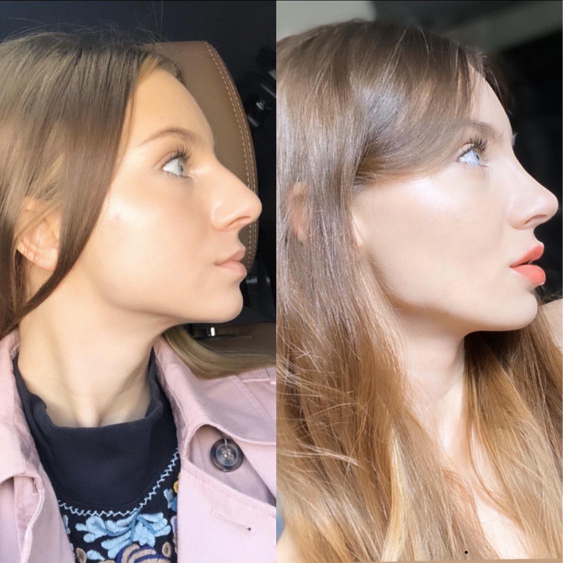 Rhinoplasty: My One Year Post-Op | Scrolller