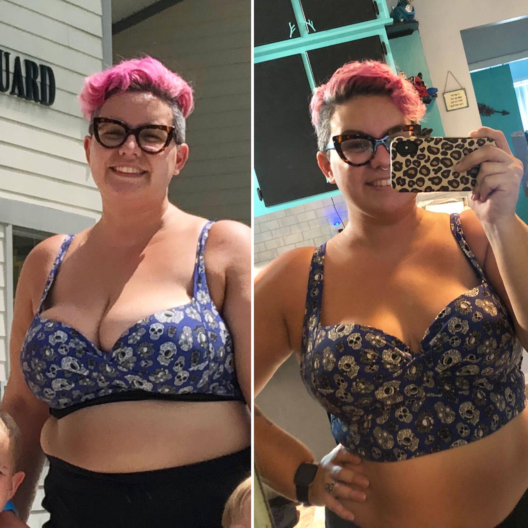 Same bikini top. 1 day pre-op and 8 days post-op. CAN YALL BELIEVE THIS MAGIC?! | Scrolller