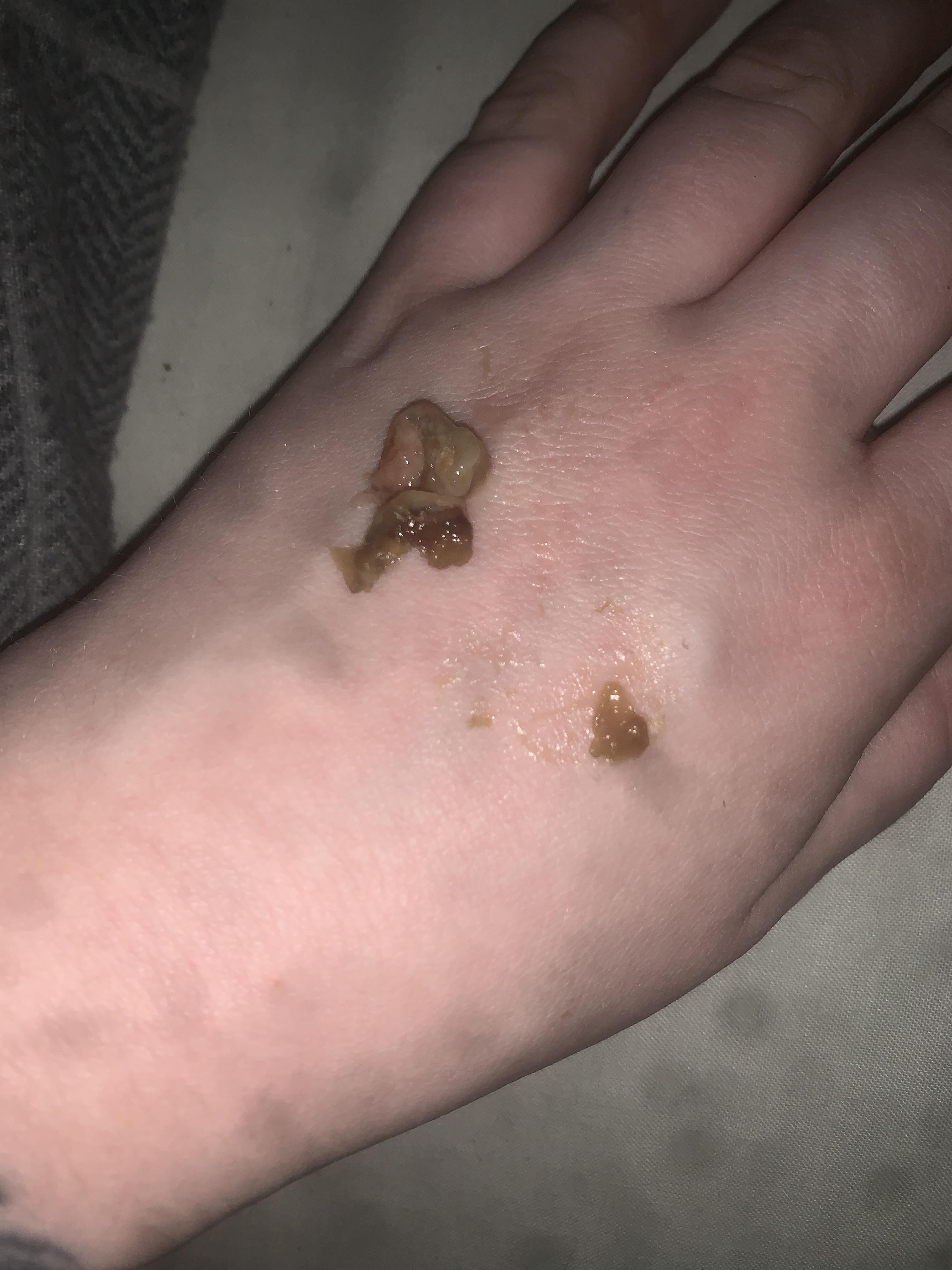 Sinus plug! 3 days solid. | Scrolller