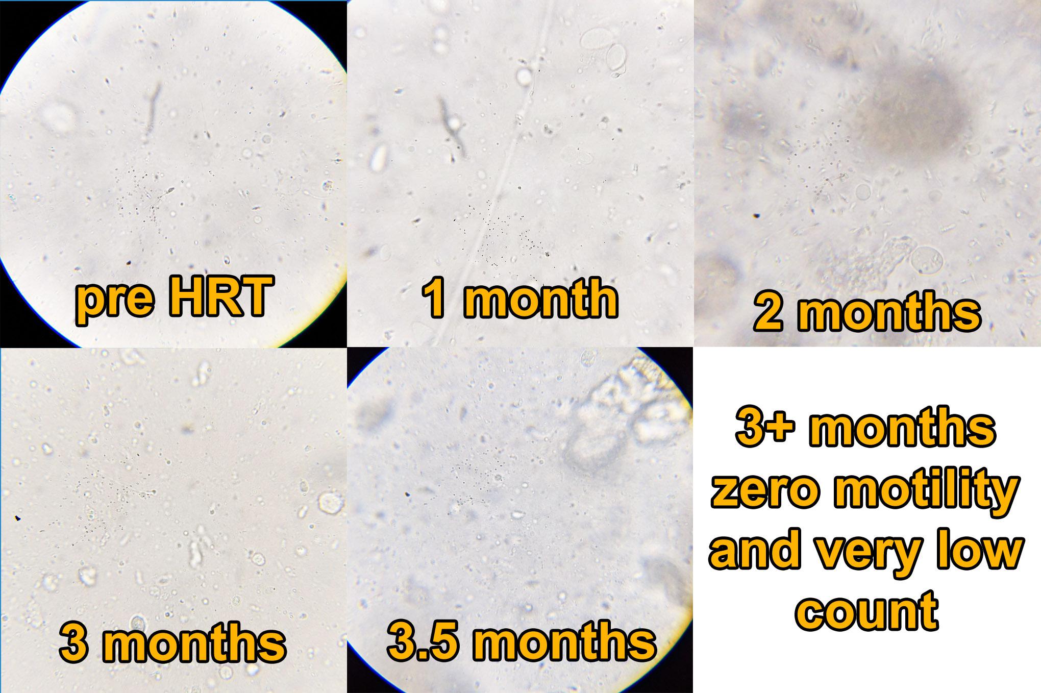 Sperm HRT Timeline | Scrolller