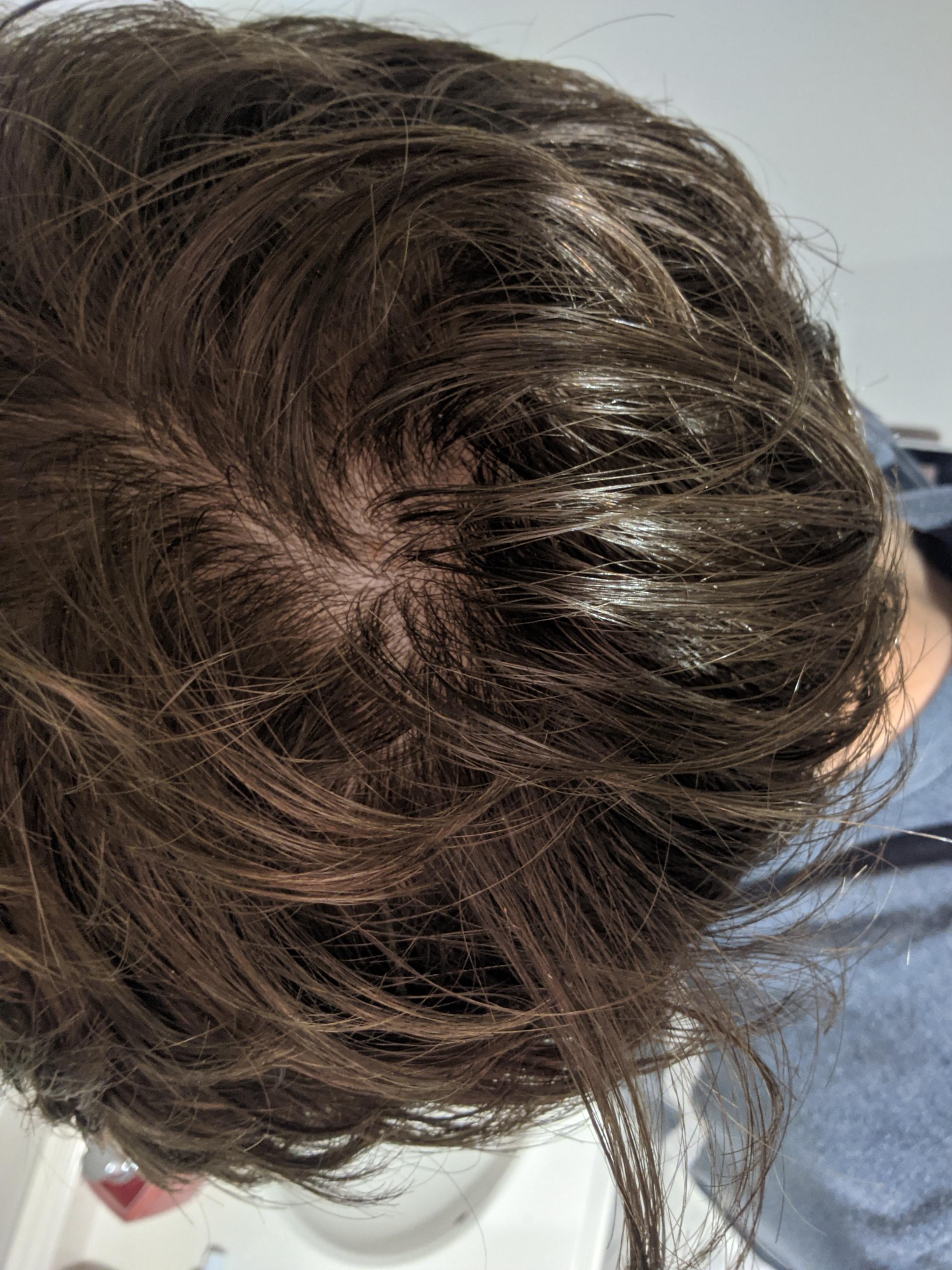 Starting bald spot or just hair partition? | Scrolller