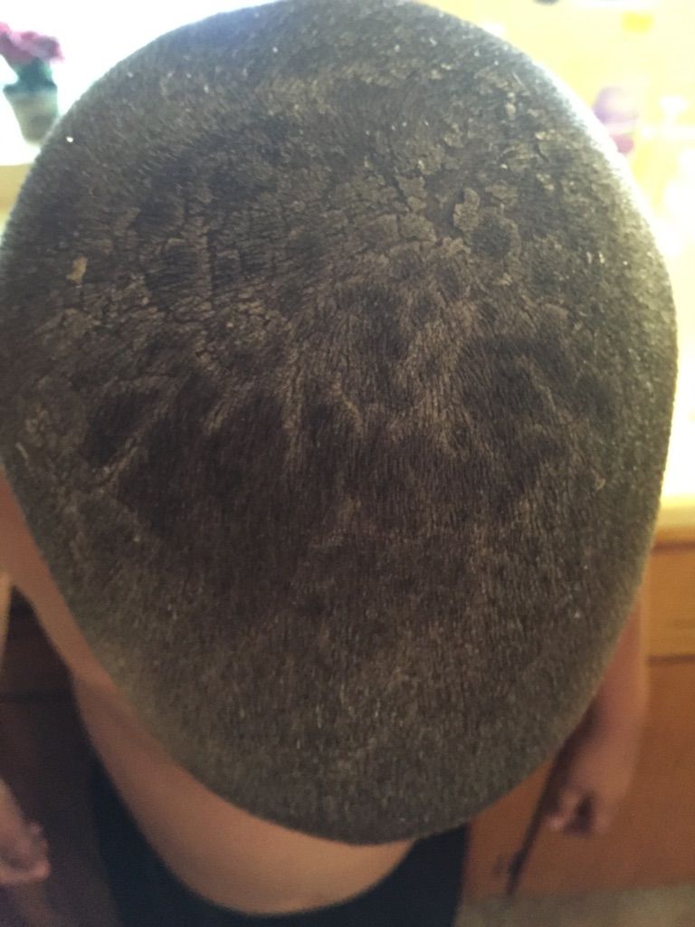 Sunburn on my sons head. | Scrolller