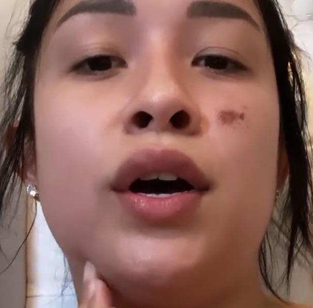 That does NOT look like a popped pimple | Scrolller