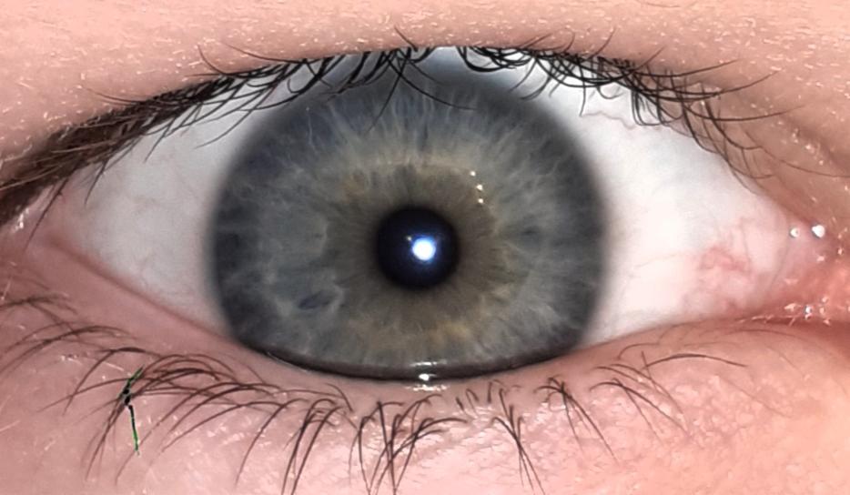 This is a better pic of my eye. | Scrolller