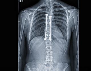This is my back after 14 years post op. | Scrolller