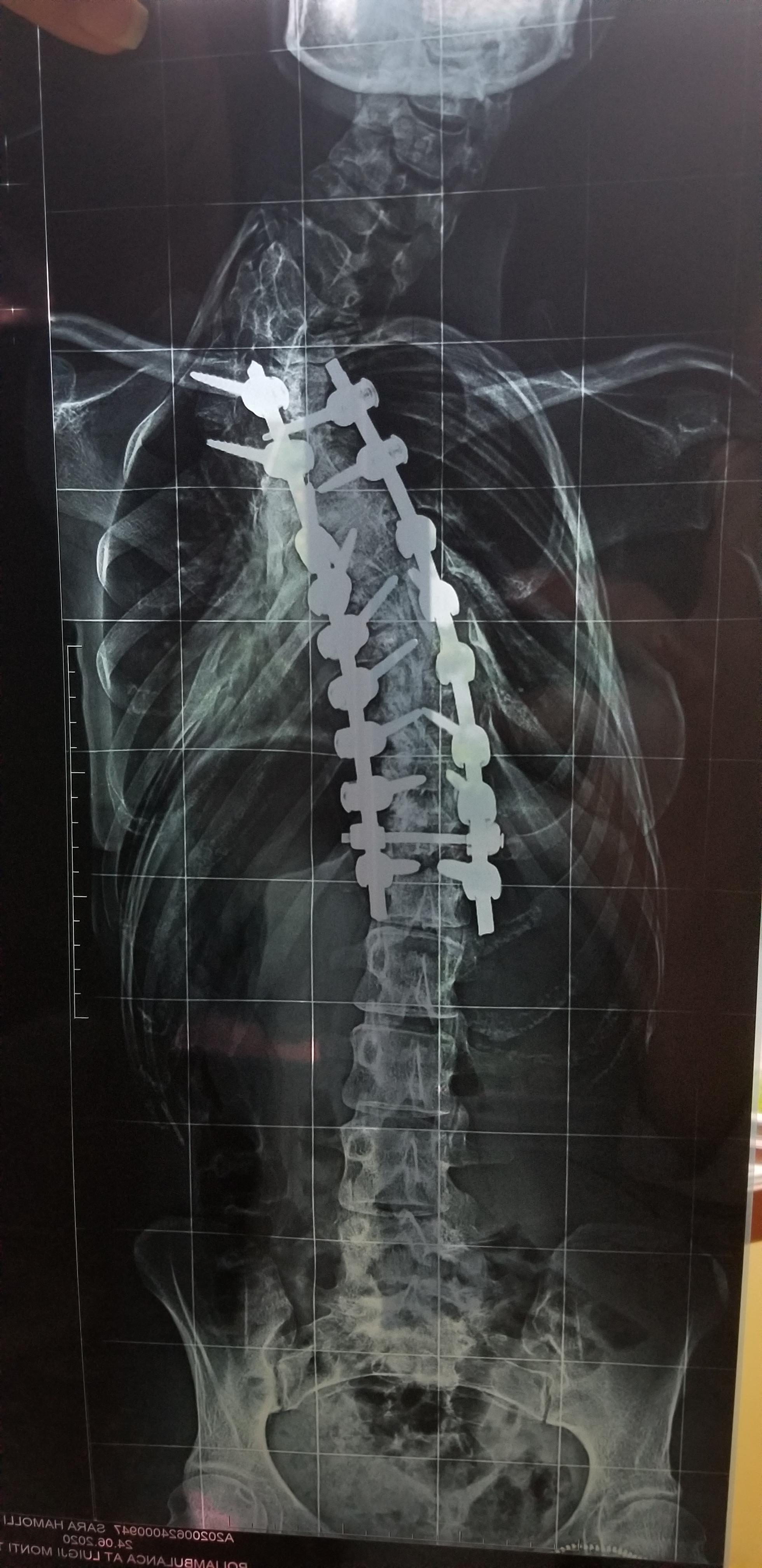 This is my xray post op. | Scrolller