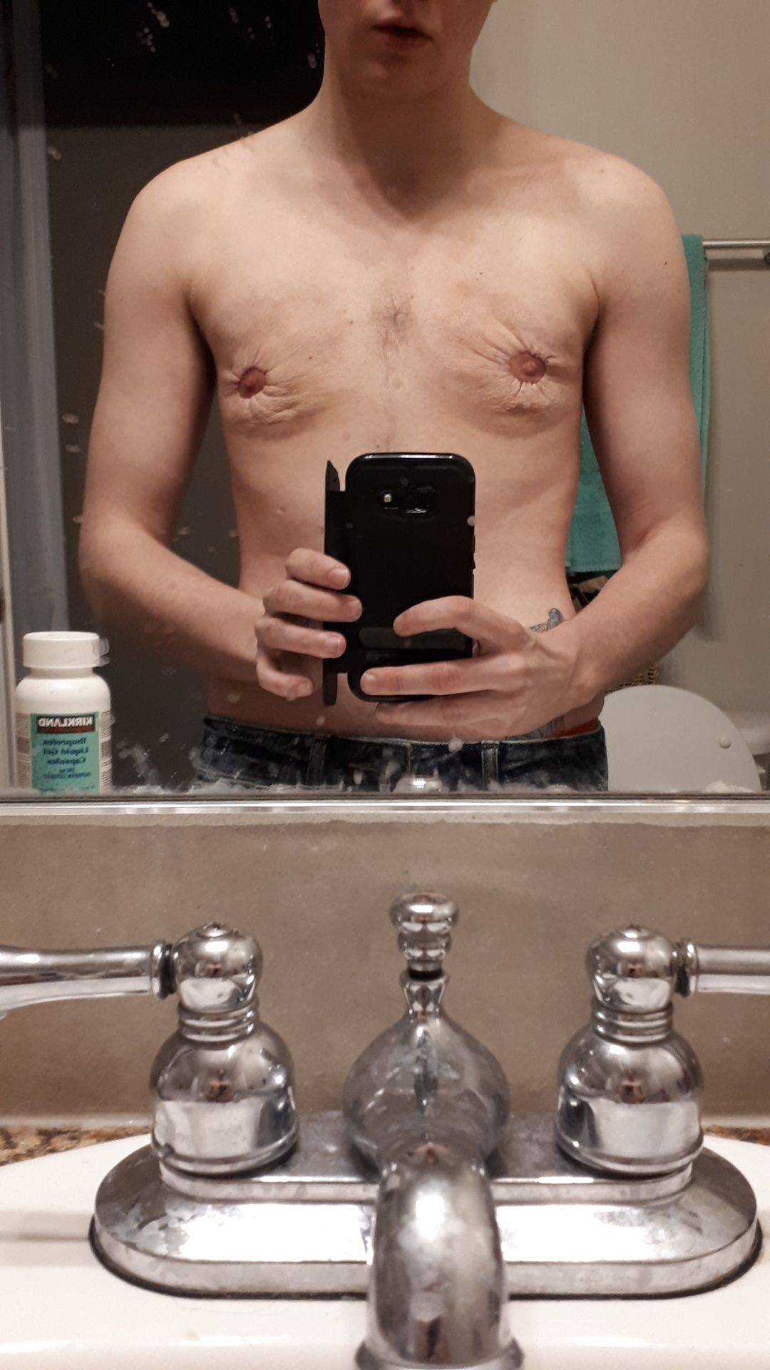 Three weeks post op. Will the wrinkles even out or am I most likely going to need revision ...