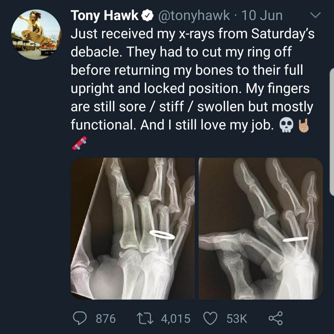 Tony Hawk sharing his recent xray on Twitter | Scrolller