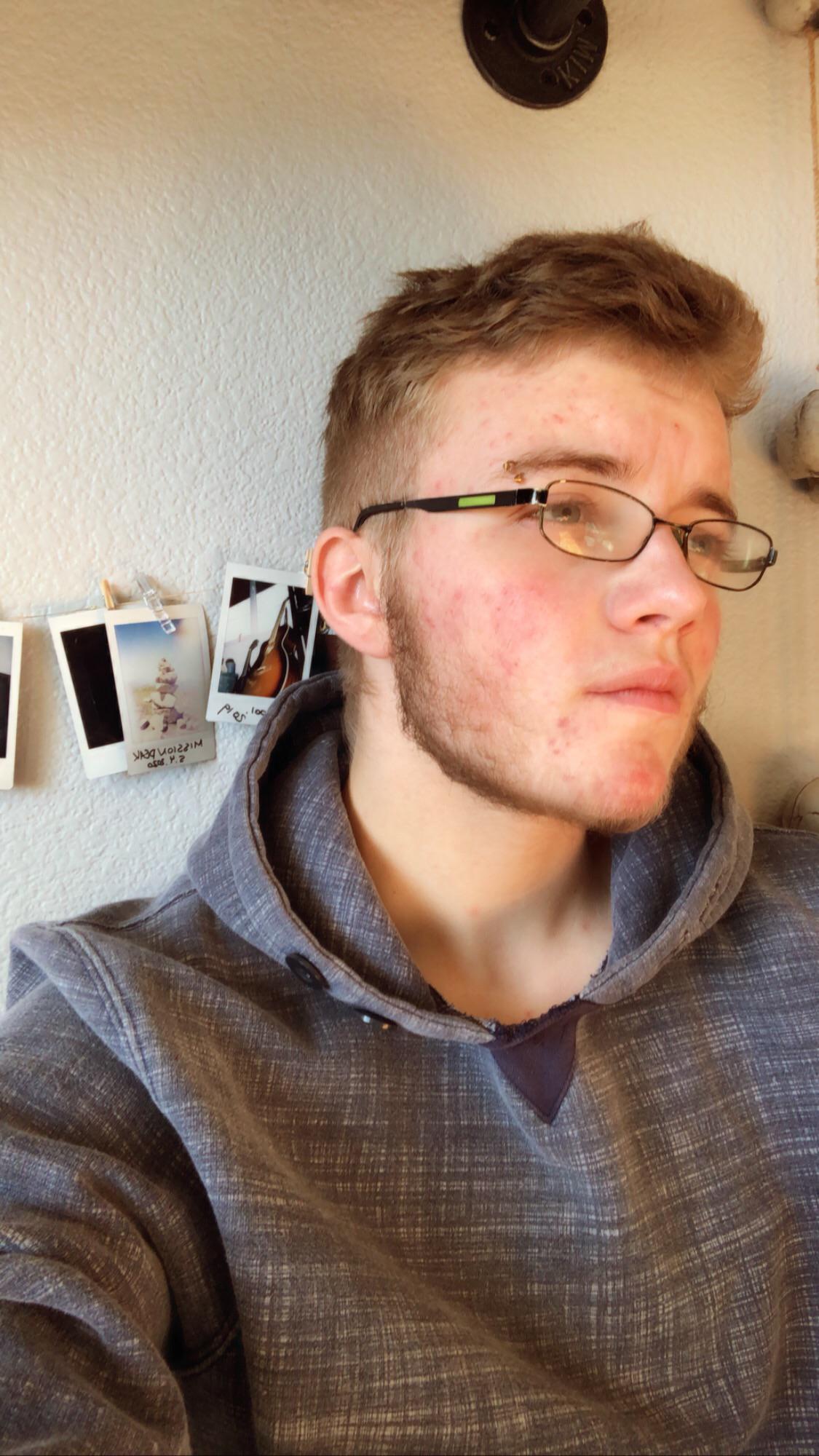 Turning 21 tomorrow. :) (11 months on T) | Scrolller