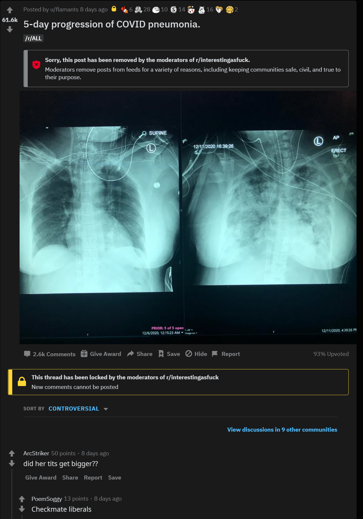 Two in one: classy comment of an ICU x-ray & censorship of a post with many awards | Scrolller