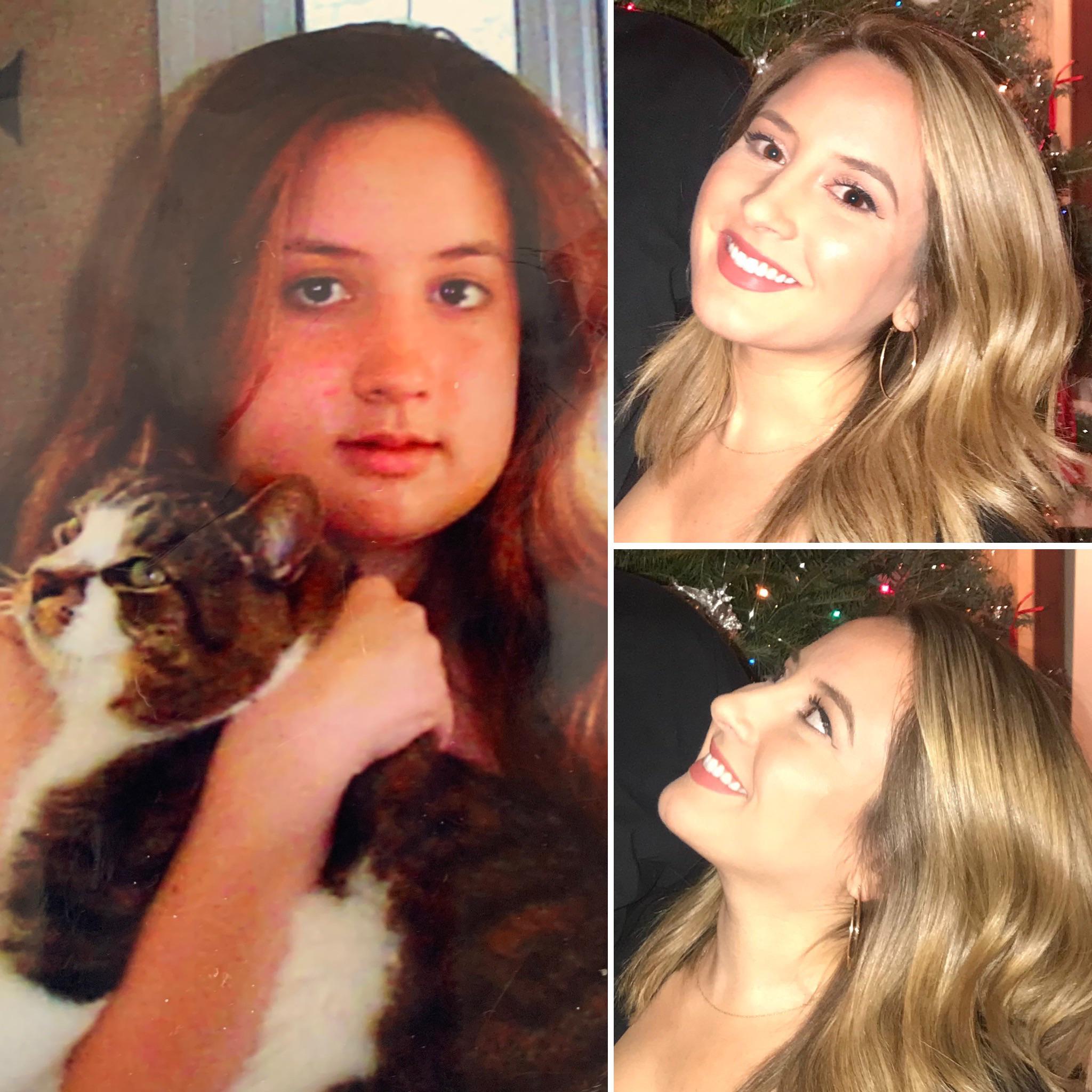 Two weeks post-op vs 17 years post-op. Still the best thing I’ve done for myself! | Scrolller