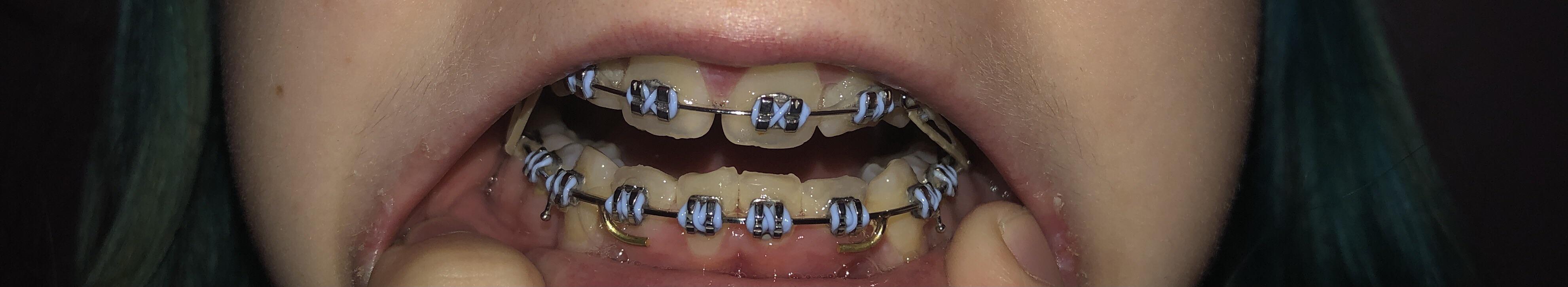 what are these gold hook things on my bottom teeth? | Scrolller