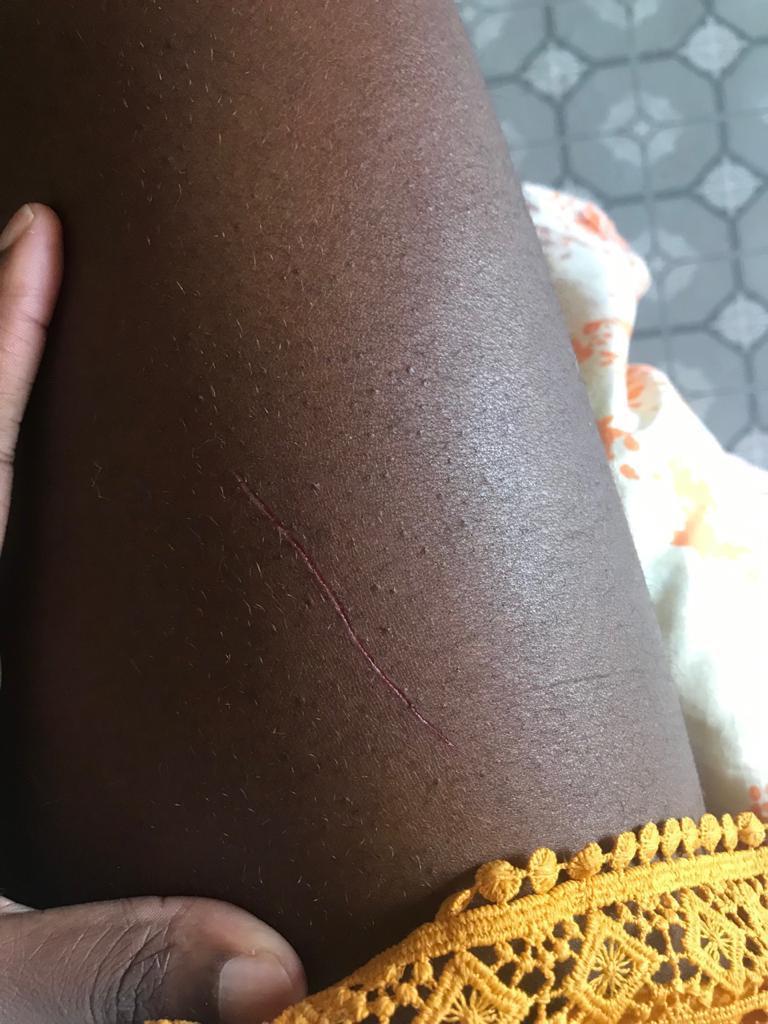 Will this leave a scar? | Scrolller