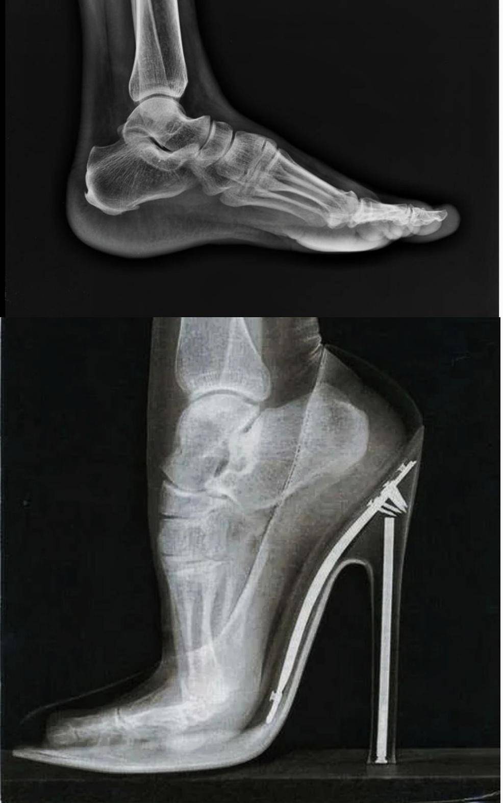 X-ray of a foot vs. foot in high heel shoe | Scrolller