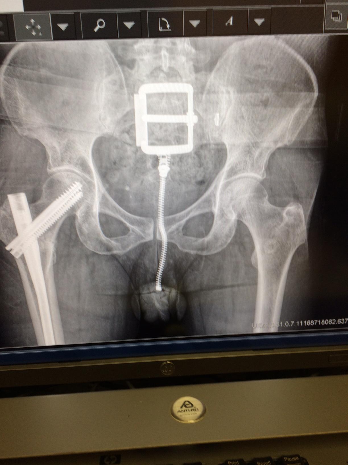 Xray of my rt femur and some misc junk. | Scrolller
