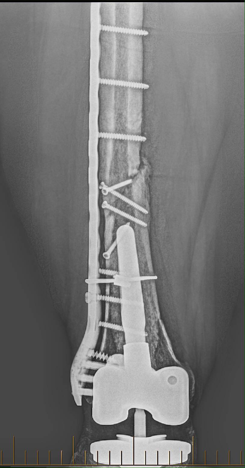 18 week follow up of broken femur X-ray. | Scrolller