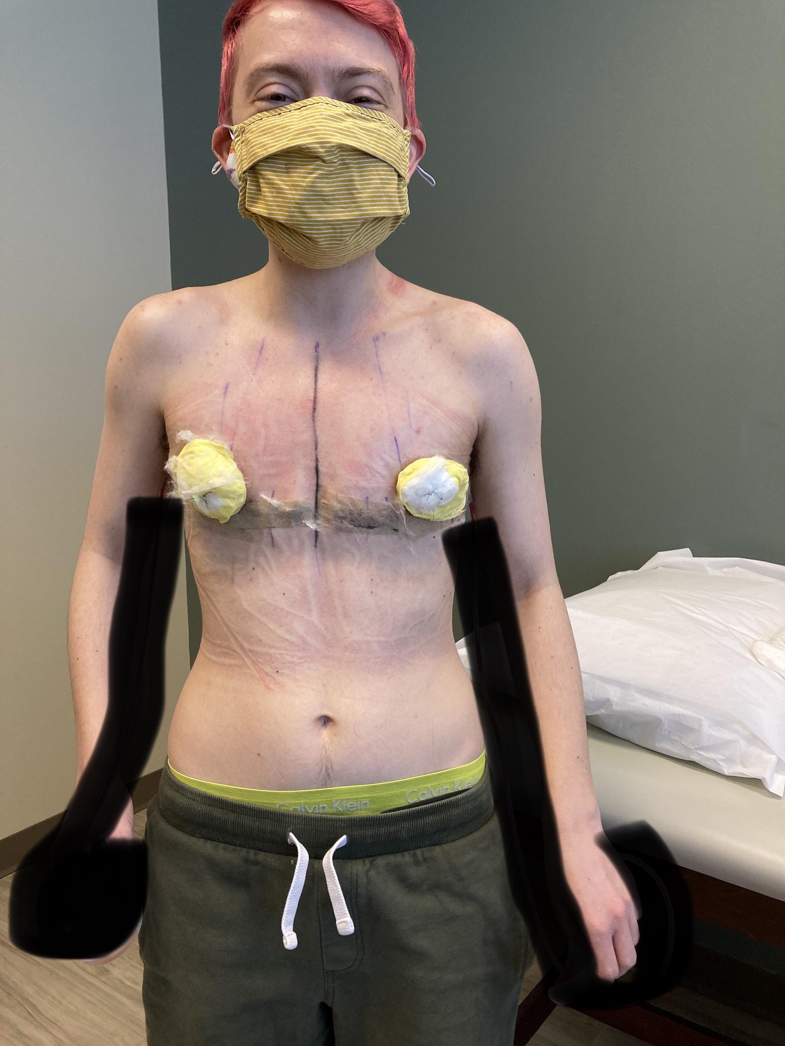 2 days post op! | Scrolller