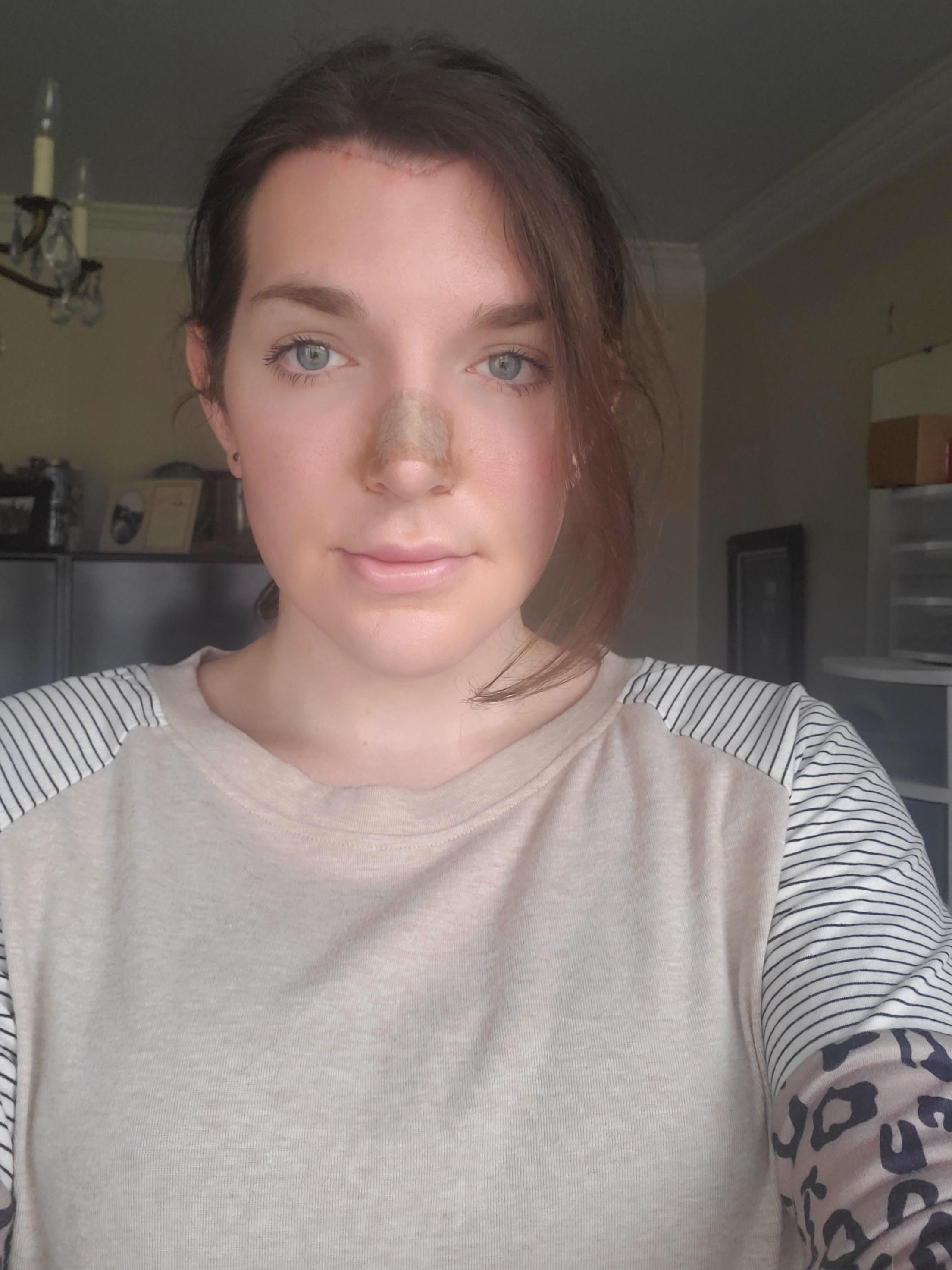 2 weeks FFS post op - did it work? 😳 Very hard to not hone in on certain features I am insecure ...