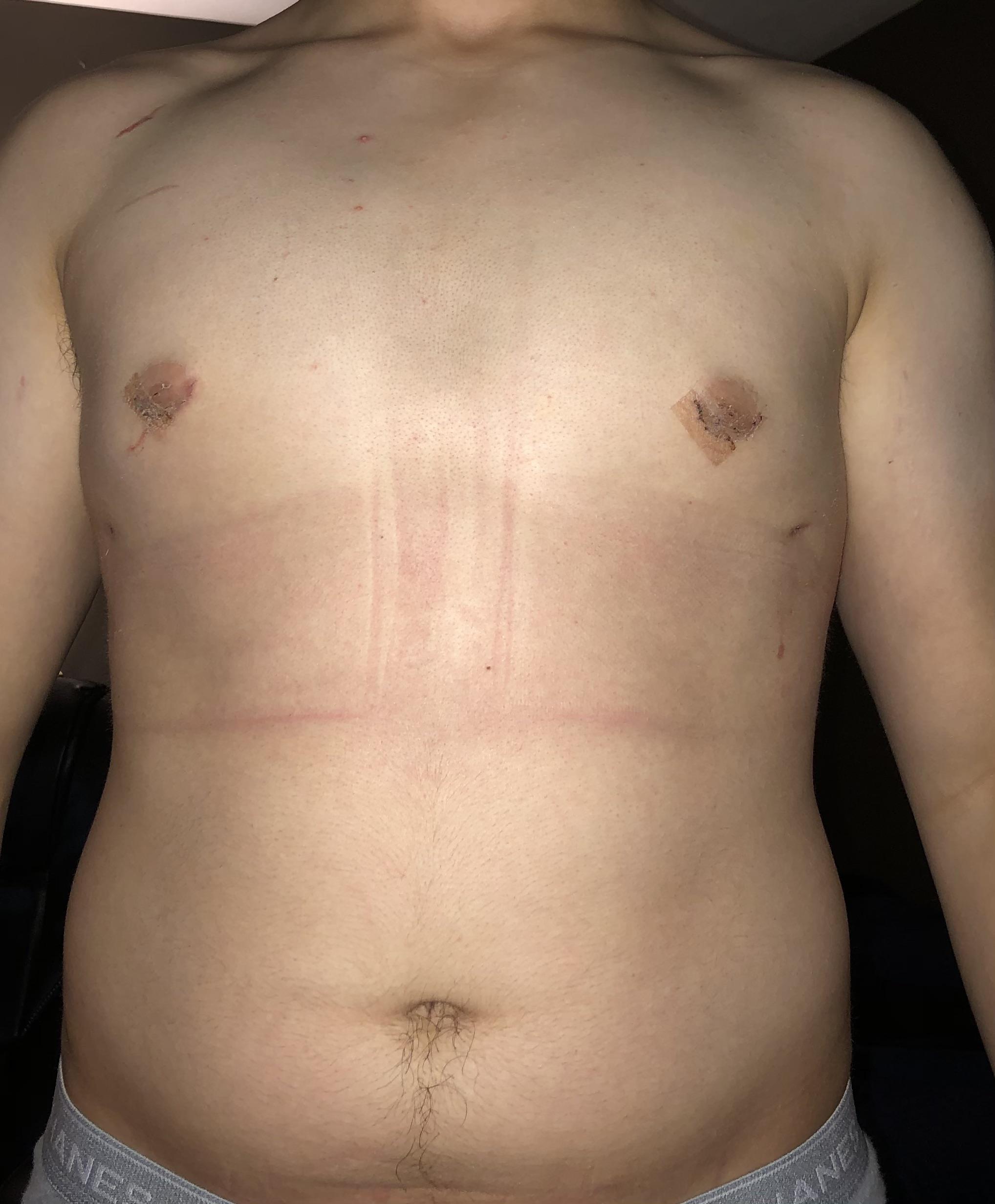 2 Weeks Post-Op | Scrolller