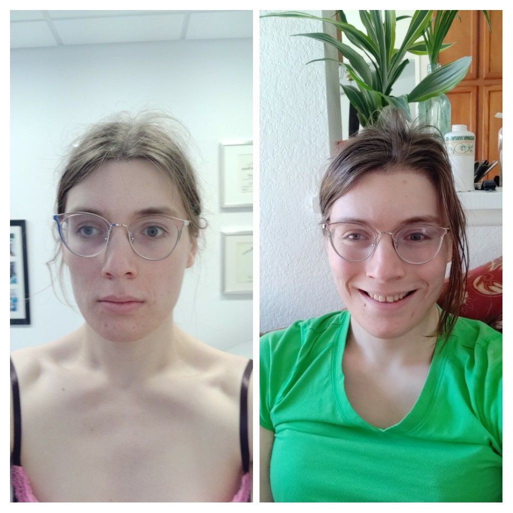 3 months post op FFS with Dr. Sinclair in LA | Scrolller