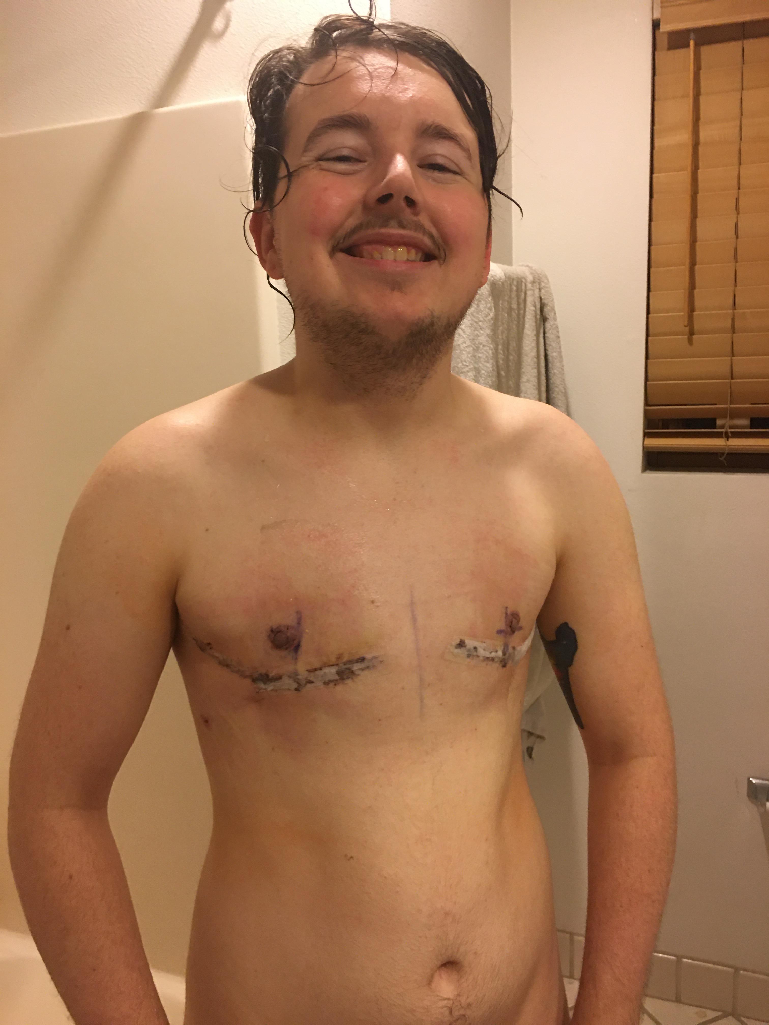 5 days post op!! Feeling good! | Scrolller