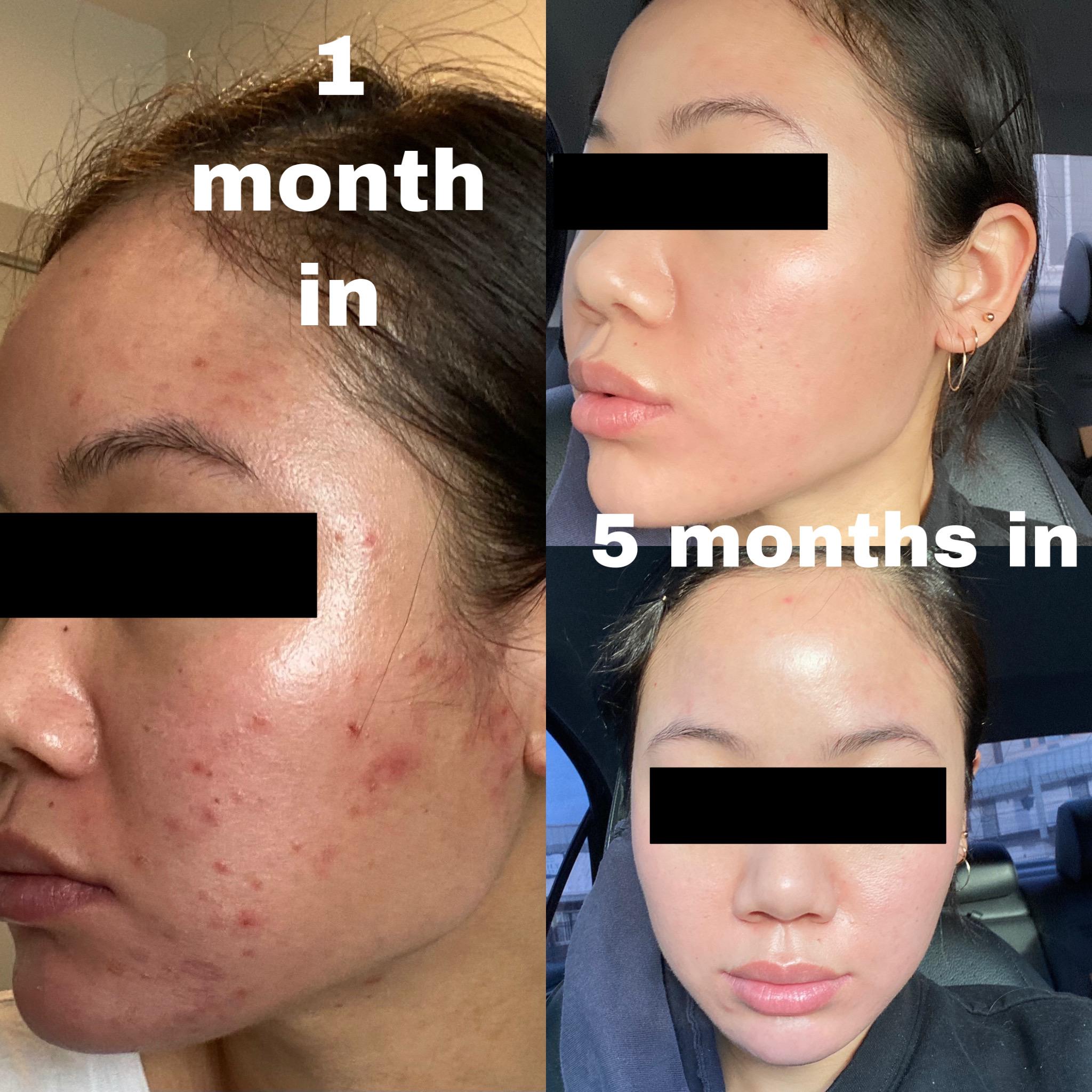 5 Months on .05% Apostrophe | Scrolller