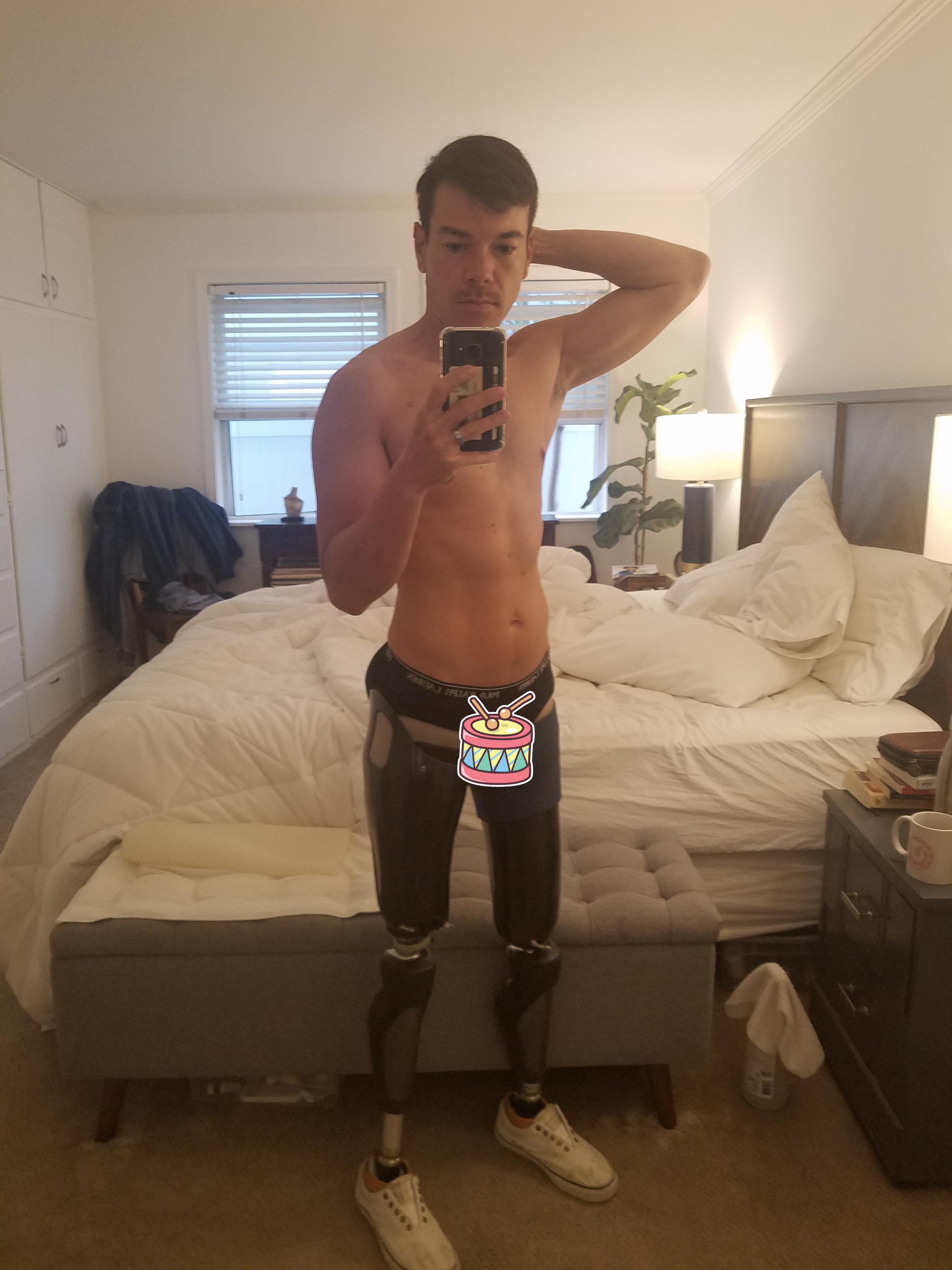 Amputee Progress Update | Scrolller