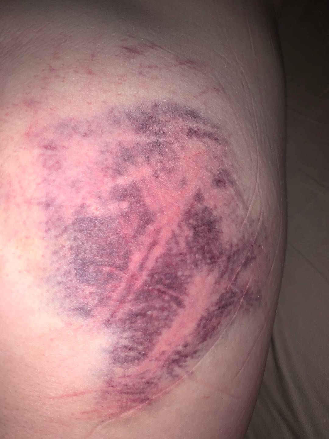 Beautiful bruises | Scrolller