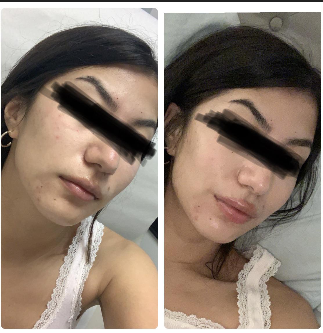 Before and after 1 syringe of Juvederm XC + cheek filler | Scrolller