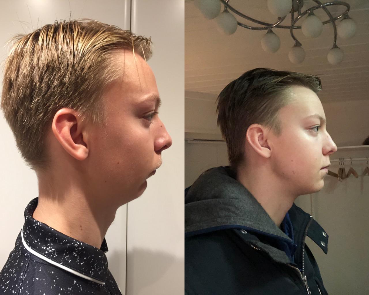 Before and after 6 weeks post op. | Scrolller