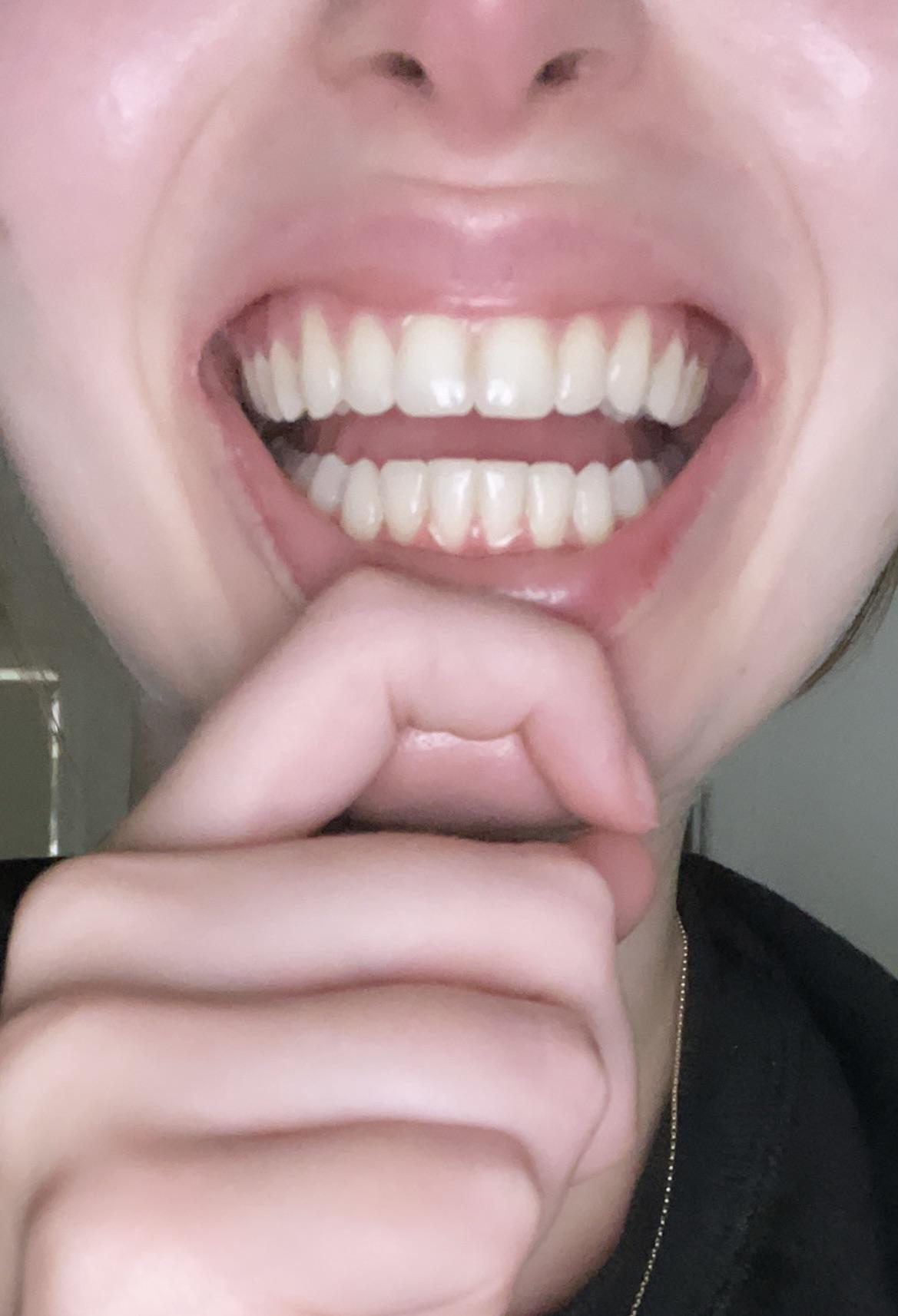 Braces Are Off Scrolller